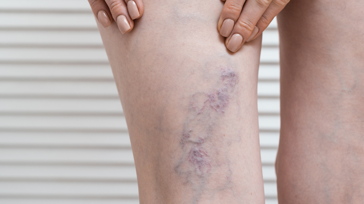 Esclerosis de varices – Dr. Federico Grasa González