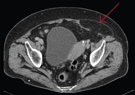 Hernia de Spiegel – Dr. Federico Grasa González